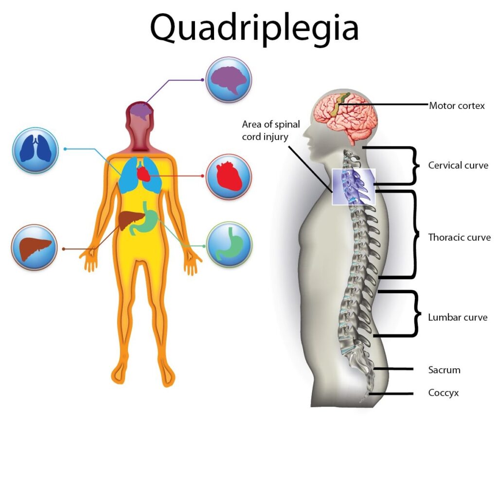 Quadriplegia - Neuromedy