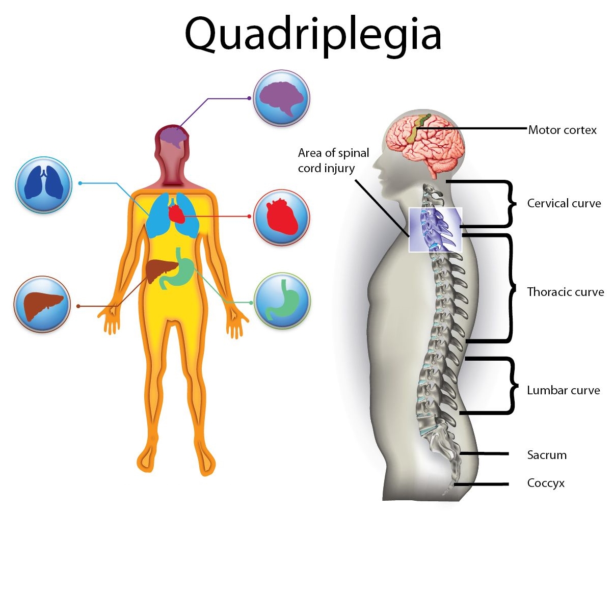 What Is Quadriplegia Paralysis at Clara Moran blog What Is Quadriplegia Paralysis at Clara Moran blog